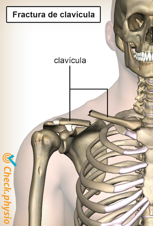 Fractura de clavícula | Causa, síntomas y tratamiento