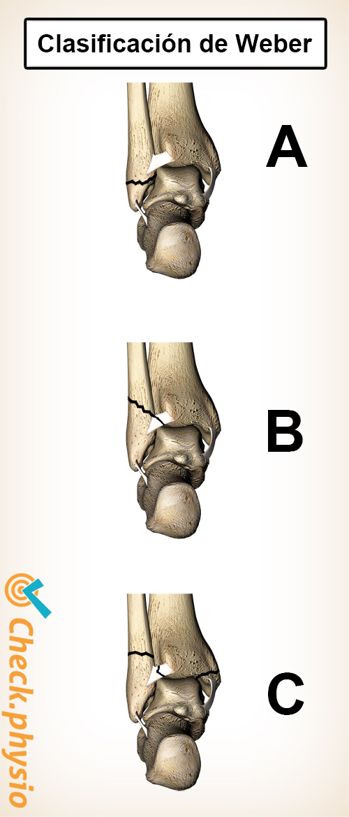 Fractura de tobillo | Causa, síntomas y tratamiento